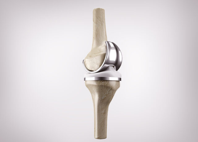 Prothèse totale du genou Chirurgie de l'arthrose du genou Nice