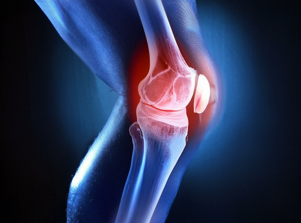 Chirurgie de la rotule du Genou à Nice - Chirurgie Orthopédique
